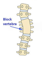 Hemivertebrae and blockvertebrae | Rare Care World